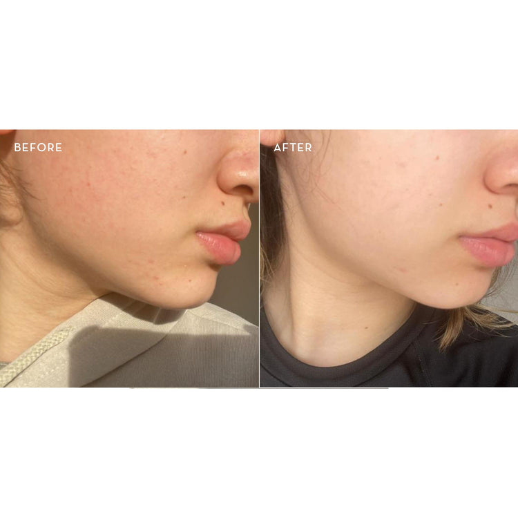 The Light Salon Boost LED Collar – The Light Salon – bluemercury